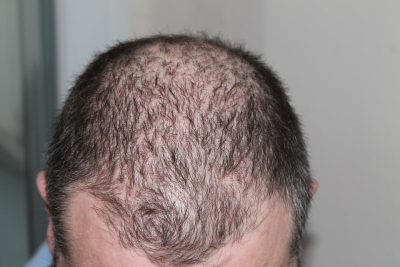 Traiter la chute des cheveux - Comment être premier sur Google et ...